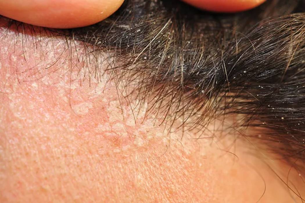 Mengenal Dermatitis Seboroik: Penyebab, Gejala, dan Penanganannya ...